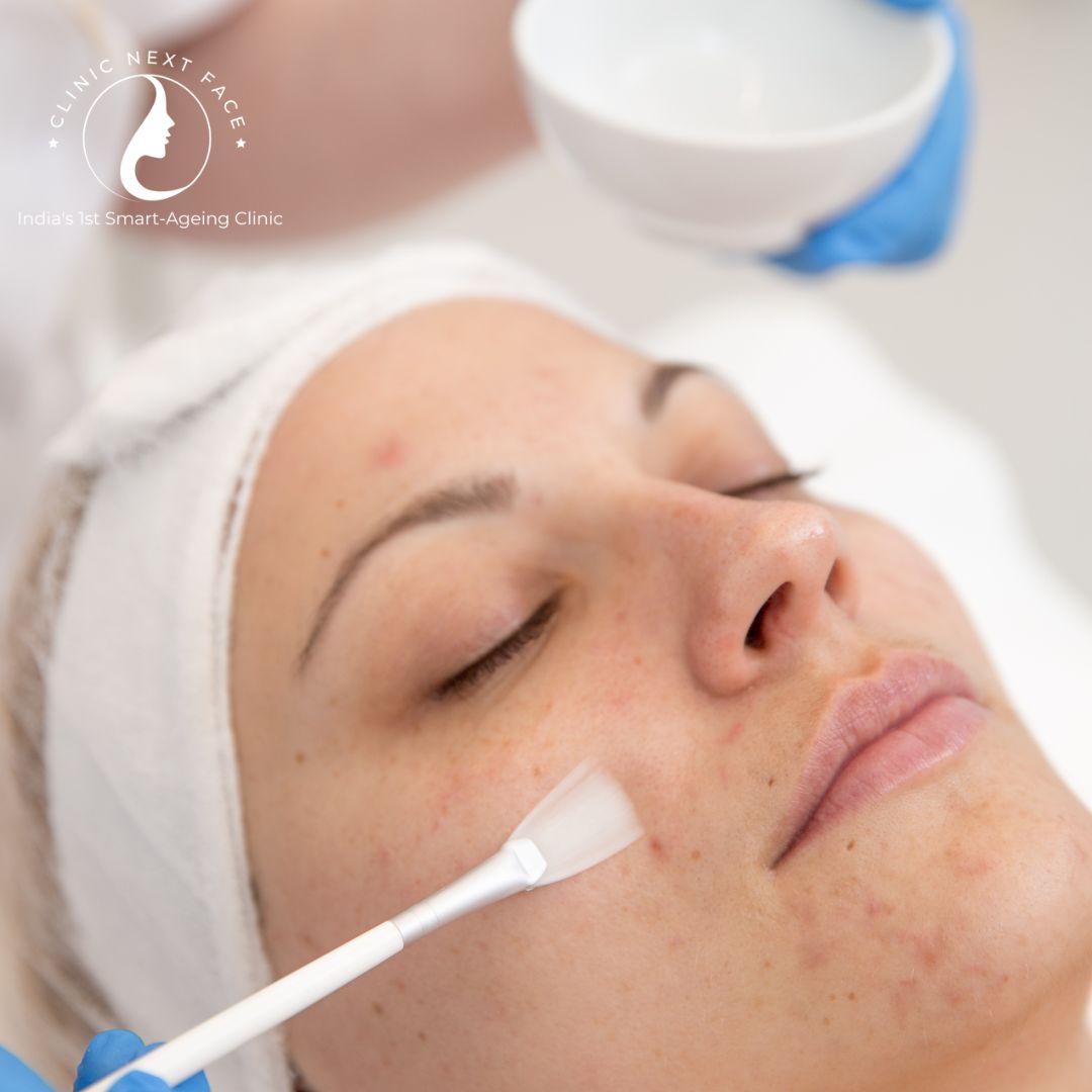 De Tan Treatment In Bangalore - Clinic Next Face