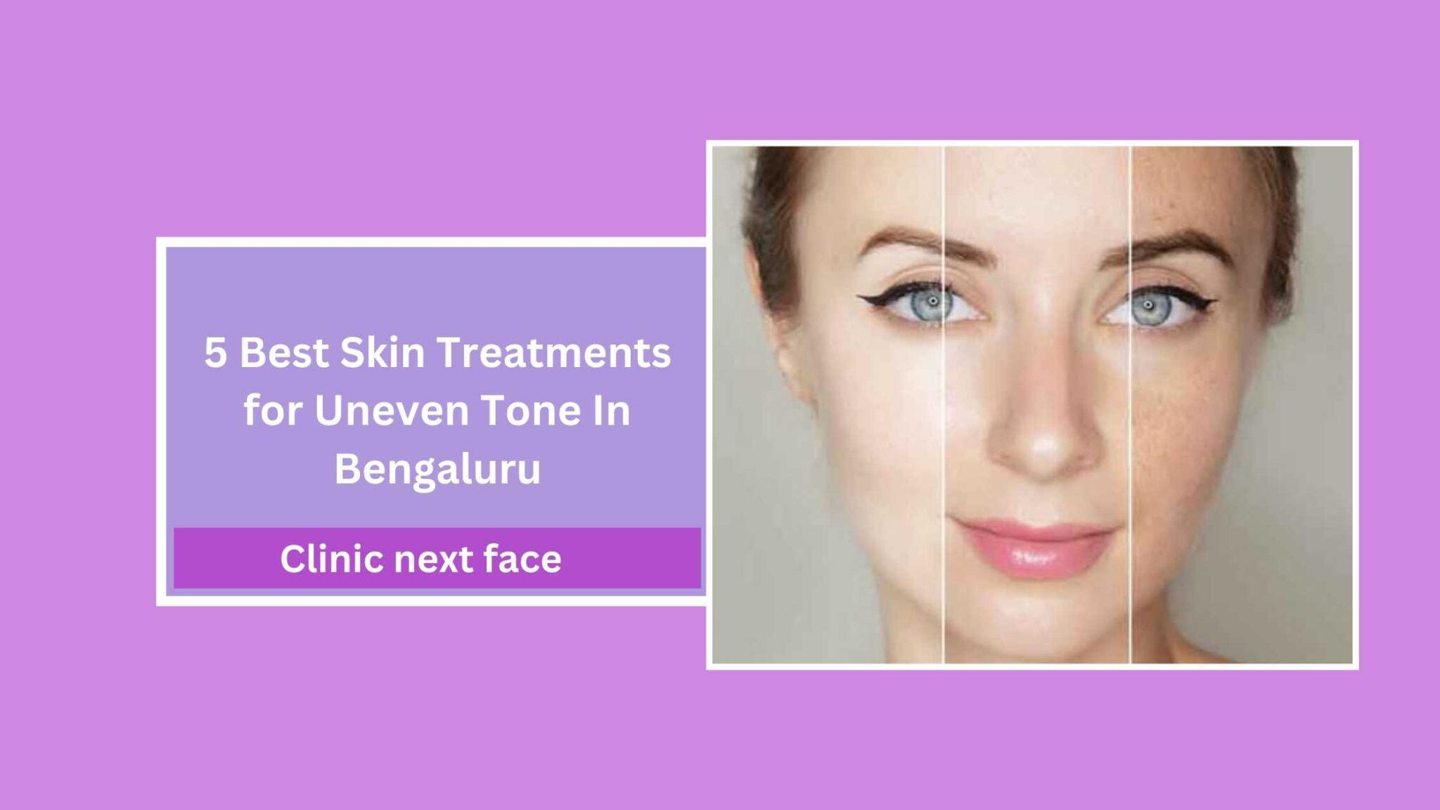 6 Best Skin Treatments for Uneven Tone In Bengaluru - CNF